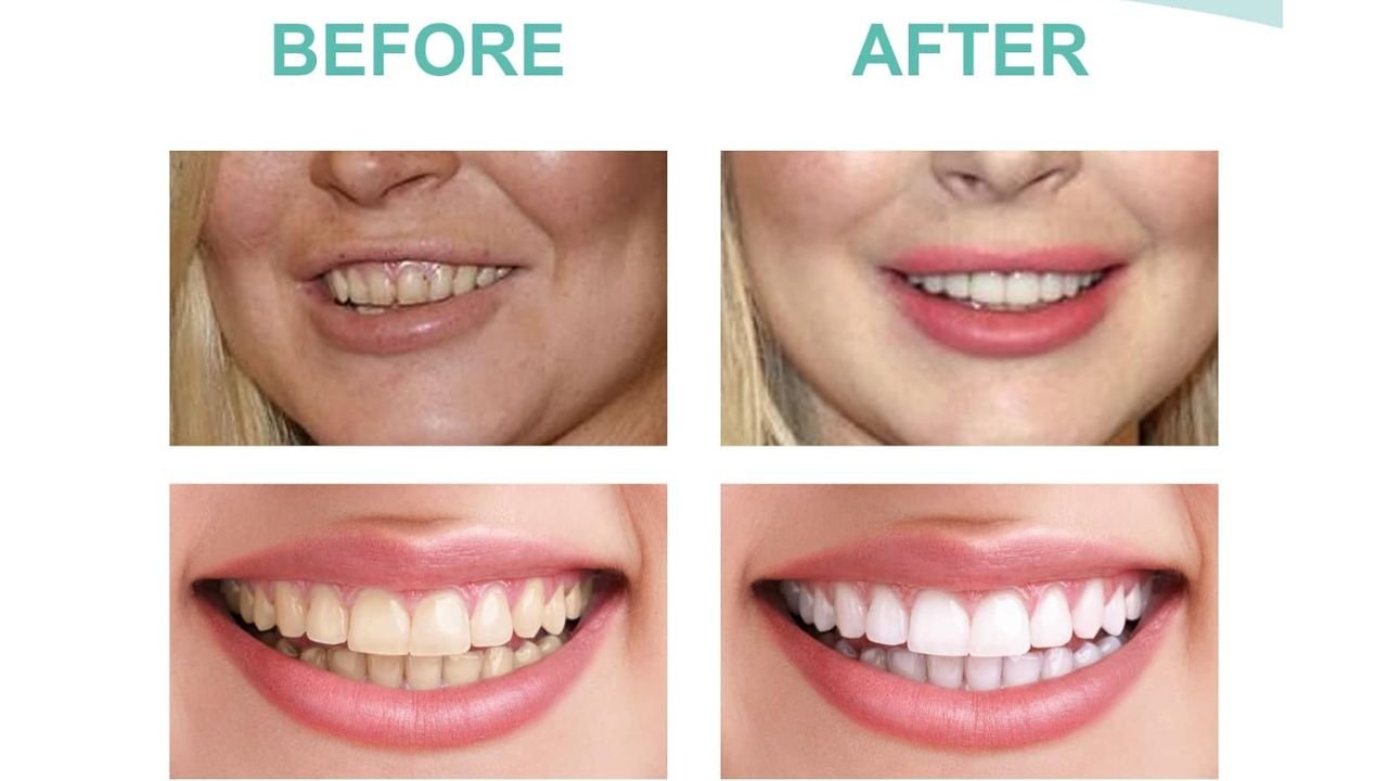 Are Snap On Teeth Reusable? - The Dental Healers