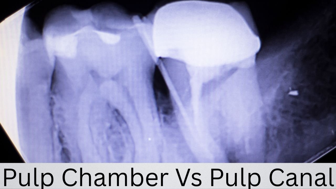 Pulp Chamber Vs Pulp Canal - The Dental Healers